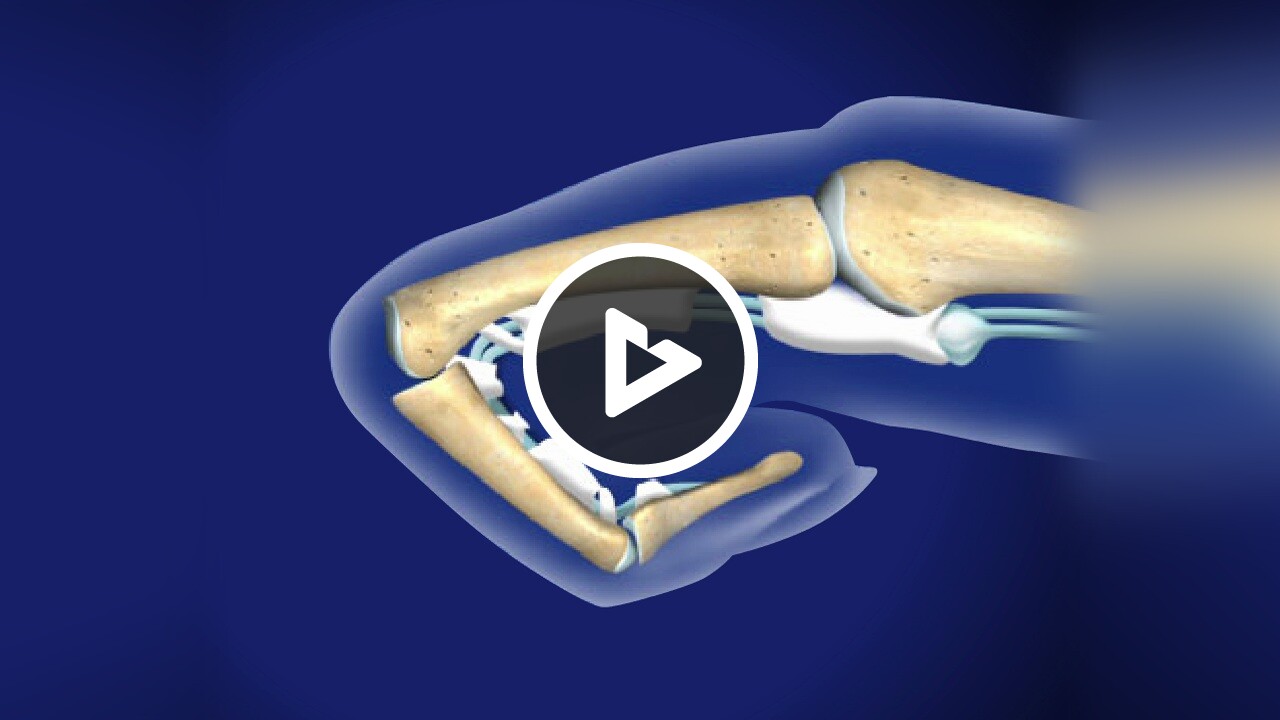 Trigger Digit - Hand, Wrist & Elbow - Willis Knighton Orthopedics South ...